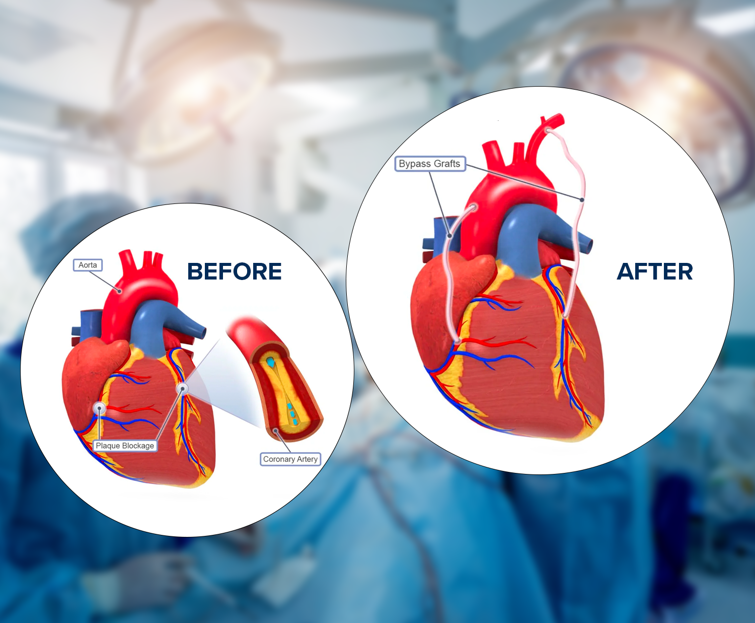 CABG Procedure Overview Dr Ramji Mehrotra